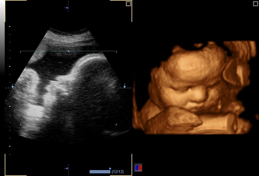 Real Clinical Benefits of Adding 3D Ultrasound